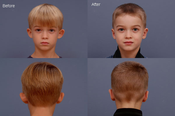 Ear Reshaping Ear Reshaping